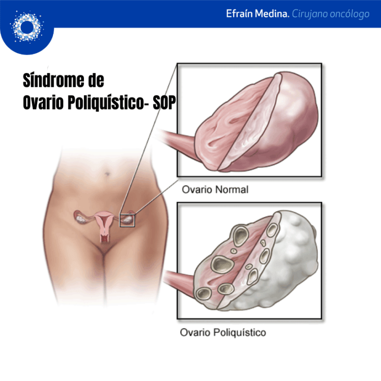 Síntomas De Quistes En Los Ovarios Después De La Menopausia Gastropatios 9084